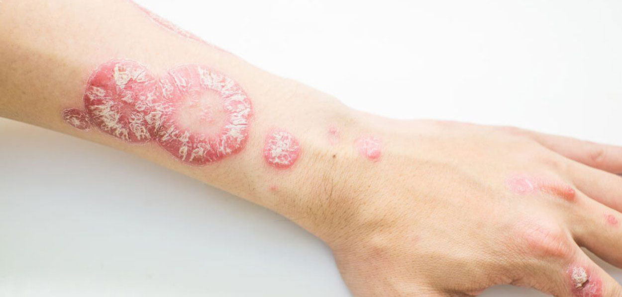 Psoriázu se dá vyléčit!